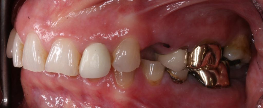Prosthodontips – managing toothwear – Dentistry Online