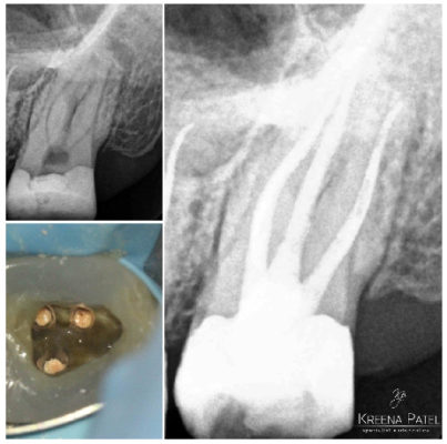 The endo expert – working length and apex locators – Dentistry Online
