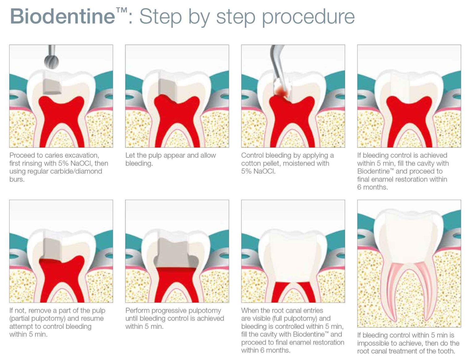 Save more teeth with Biodentine – Dentistry Online