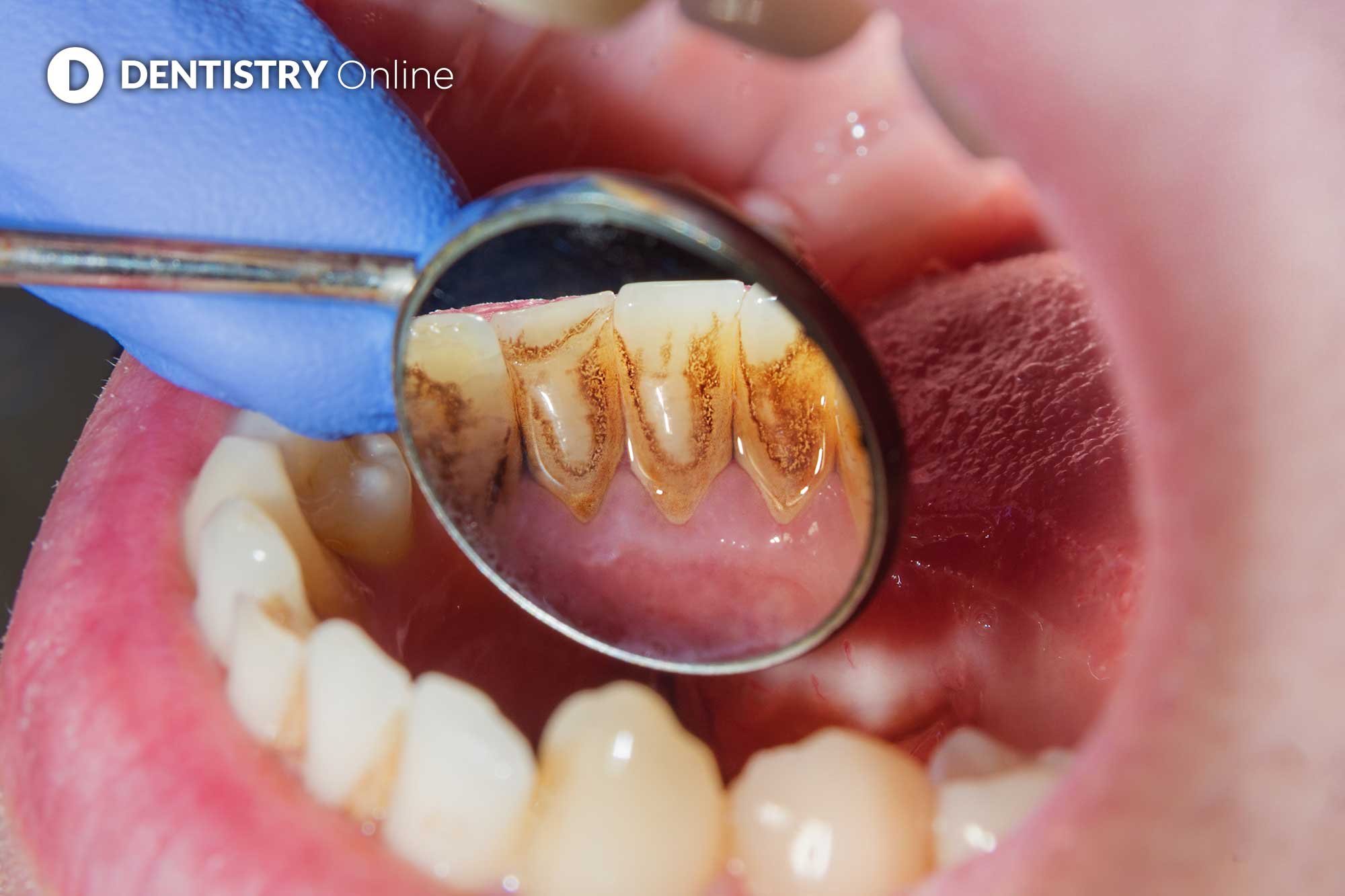 caries-risk-pandemic - Dentistry.co.uk caries-risk-pandemic - Dentistry.co.uk
