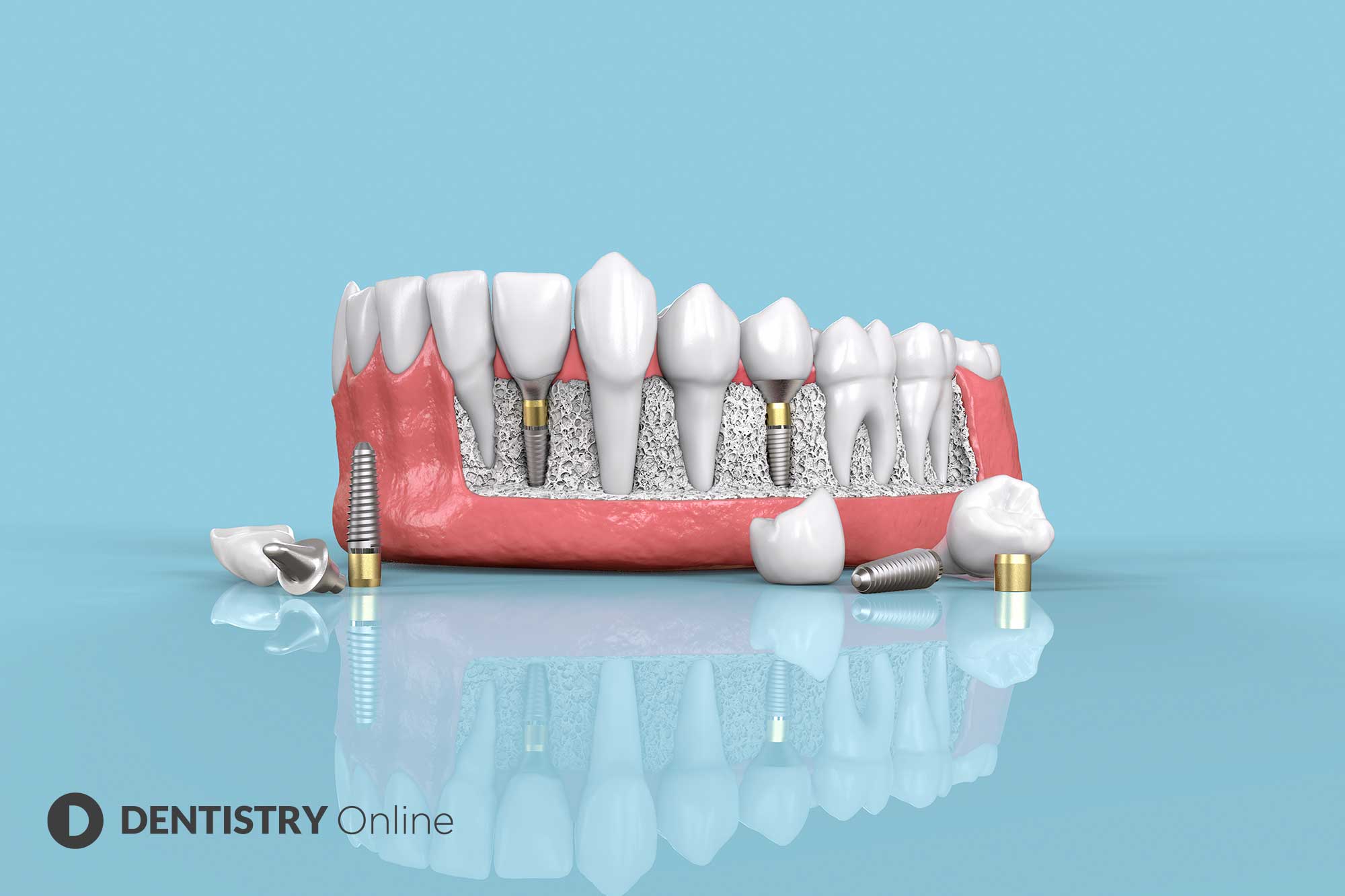 Full arch workflow – a systematic approach with Chrome – Dentistry Online