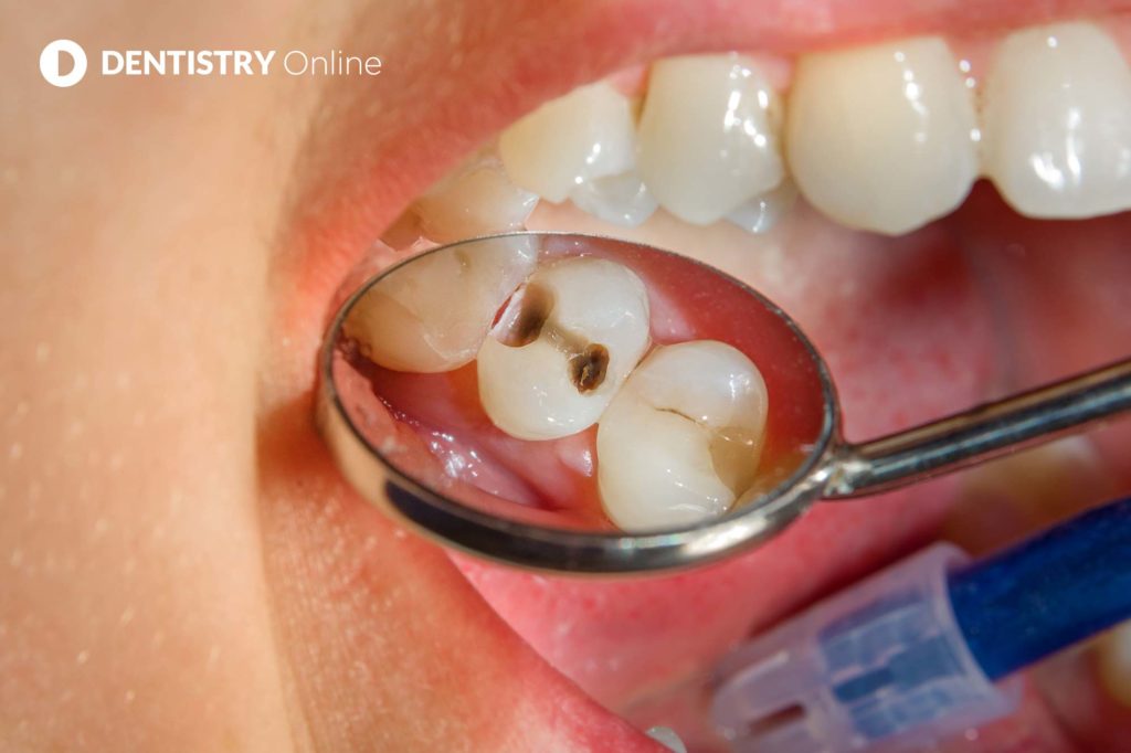 Eight in 10 at increased risk of caries, research shows – Dentistry Online