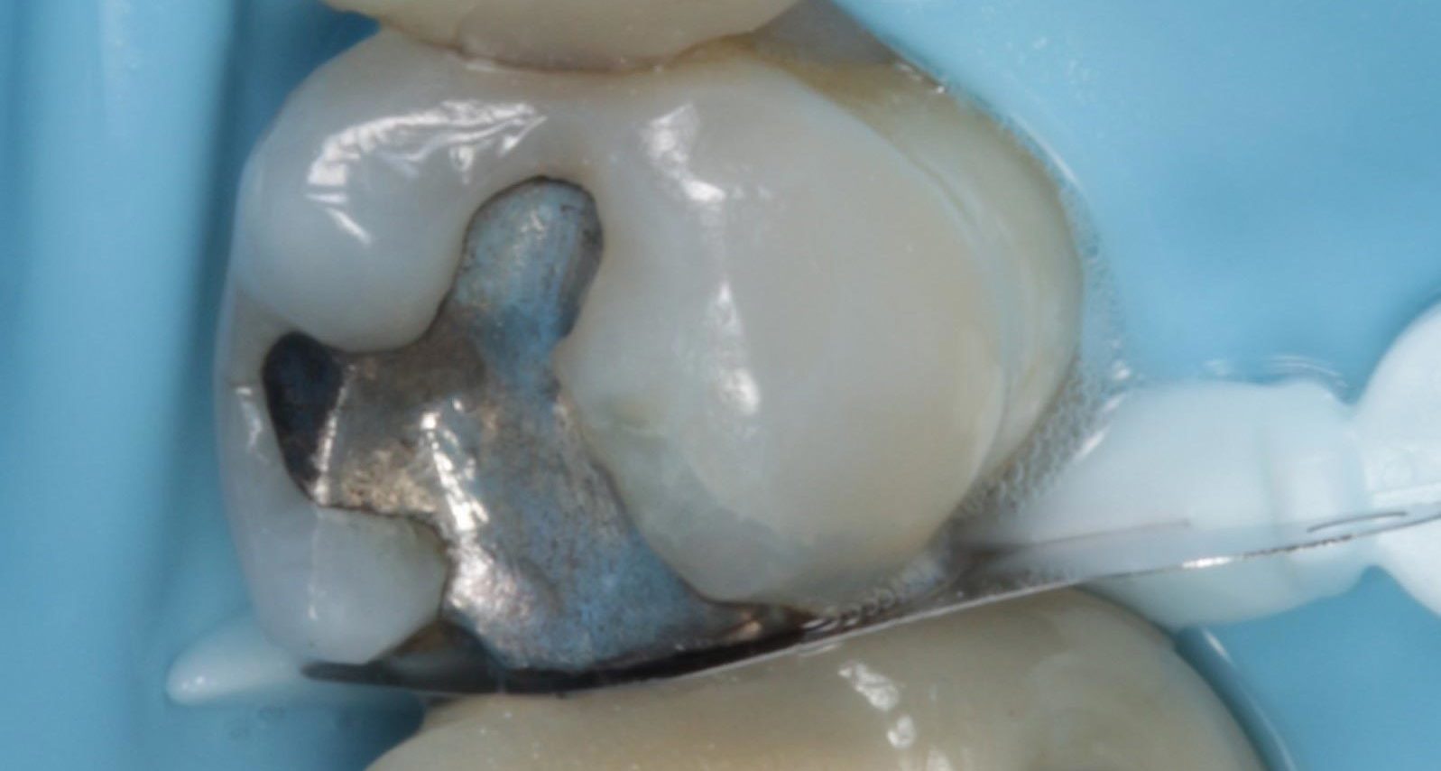 An easy fix with 3M Oral Care – Dentistry Online