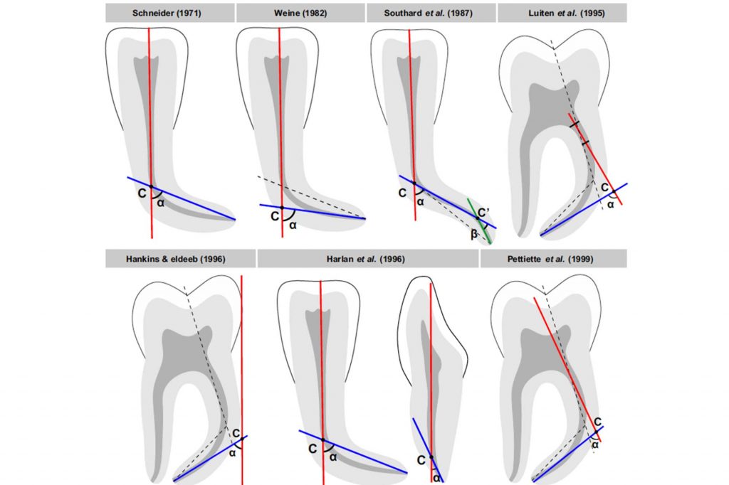 The endo expert – managing curved canals - Dentistry Online