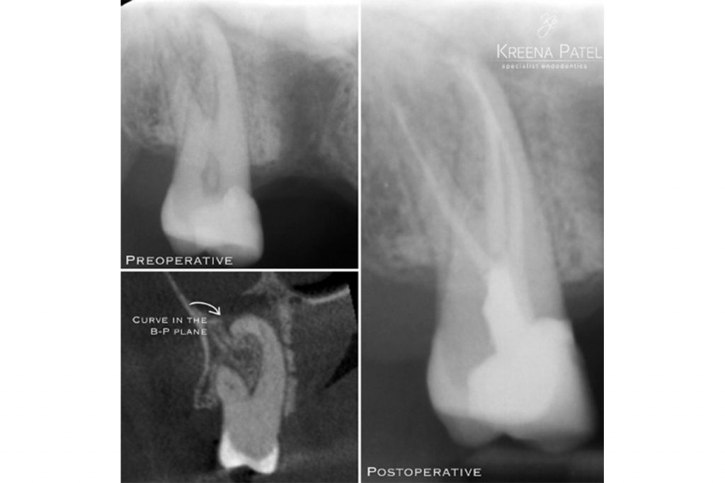 The endo expert – managing curved canals - Dentistry Online