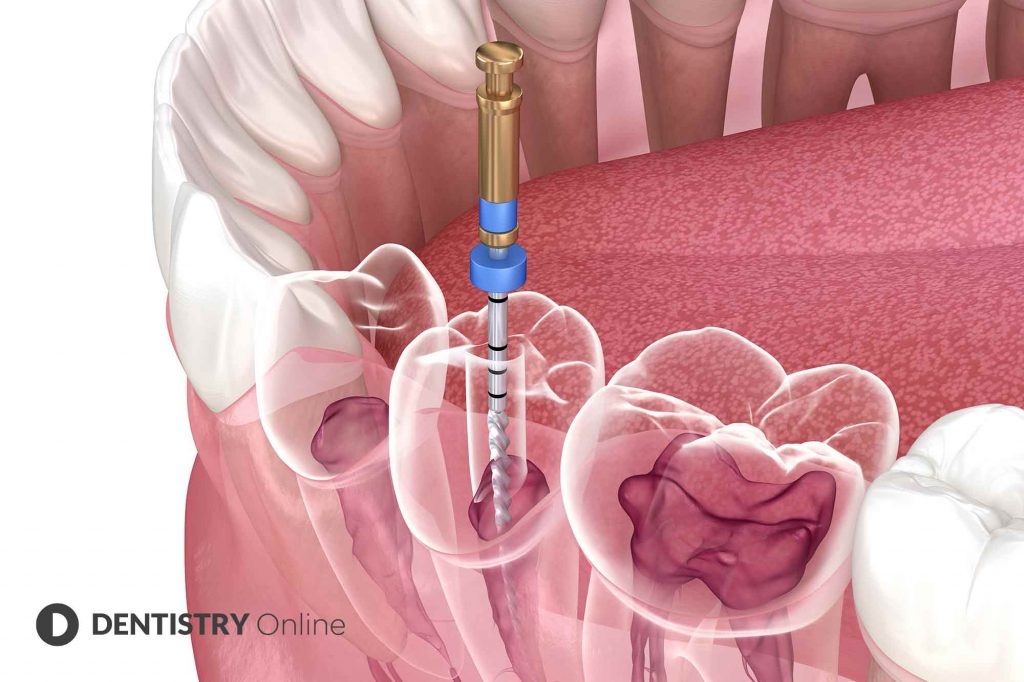 root-canal-endo - Dentistry.co.uk