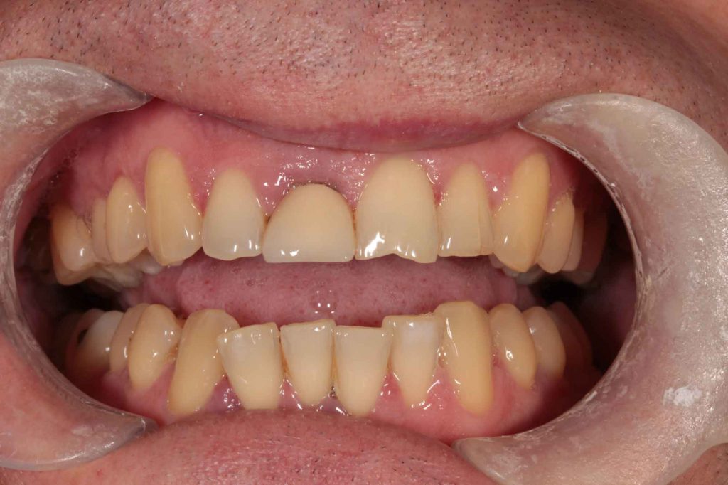 Implant insights – the immediate implant - Dentistry Online