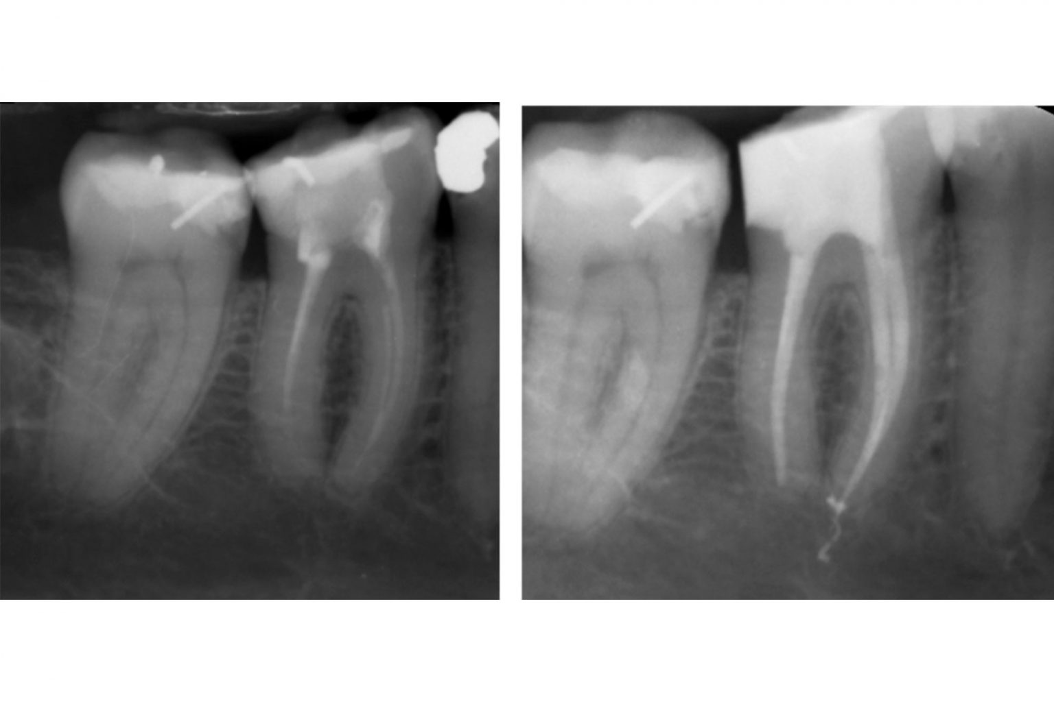 The endo expert – saving compromised teeth part 1 - Dentistry Online