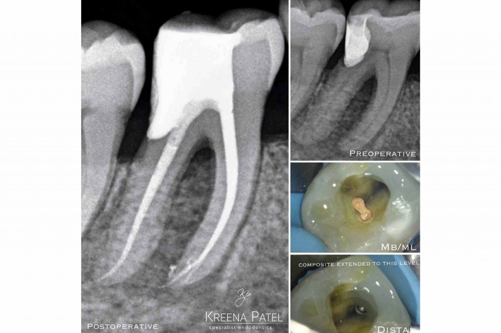 The endo expert – saving compromised teeth part 1 - Dentistry Online
