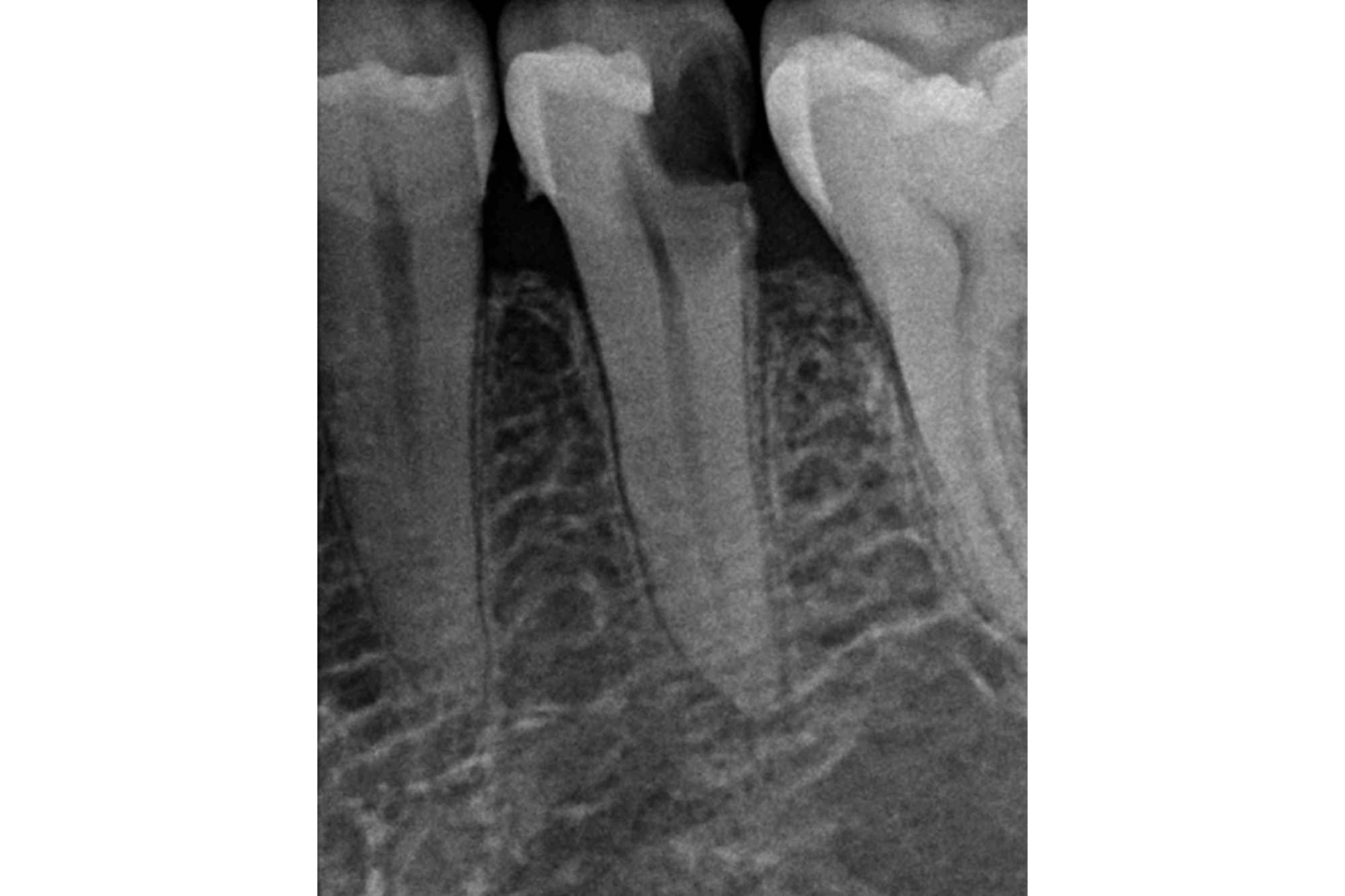 The endo expert – saving compromised teeth part 1 - Dentistry Online