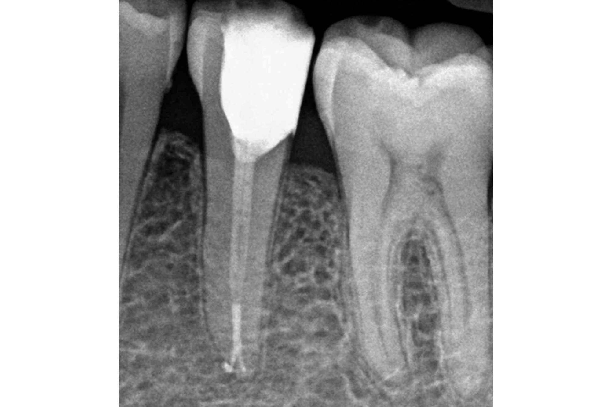 The endo expert – saving compromised teeth part 1 - Dentistry Online