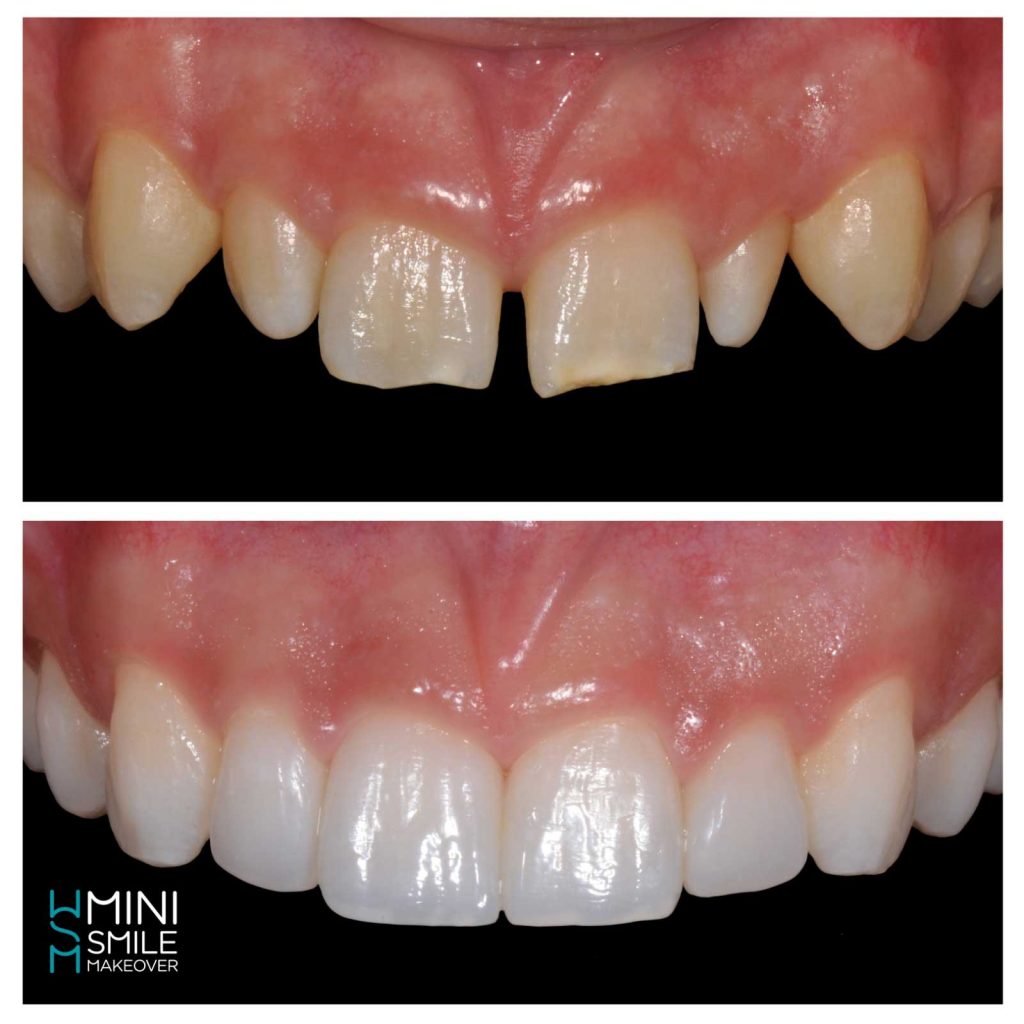 Mini Smile Makeovers – long-lasting aesthetic results - Dentistry Online