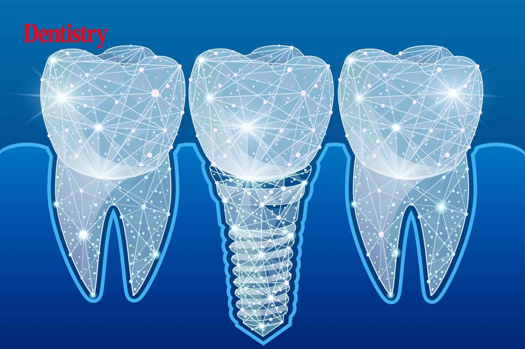 Why should I choose a digital implant workflow? - Dentistry