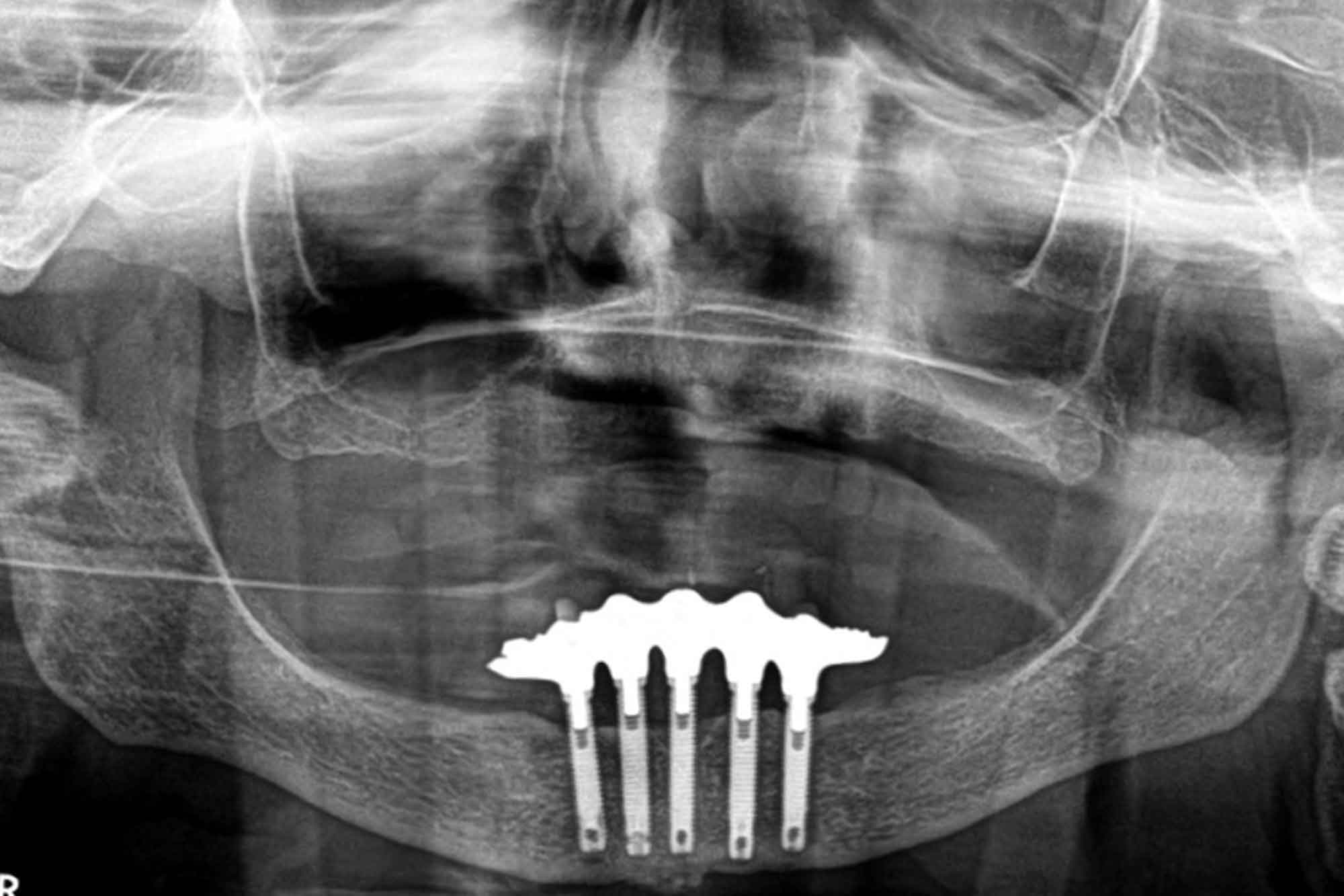 Prosthodontips – implant salvage - Dentistry