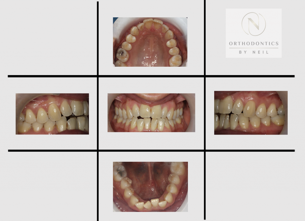 Invisalign case study part two: mild class III and overbite - Dentistry