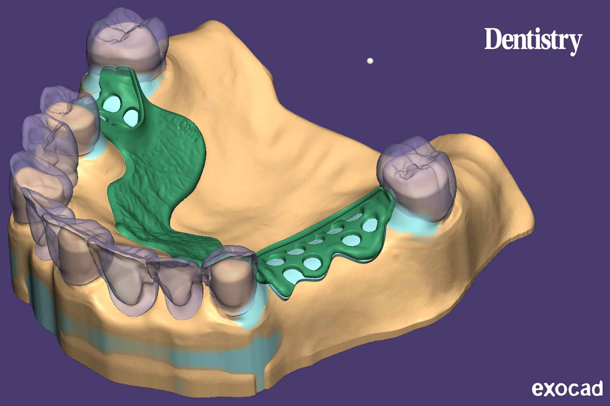 Exocad Releases Its Framework Module Partialcad 3 0 Galway Dentistry