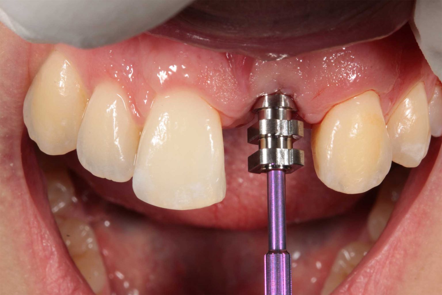 Implant insights – the implant impression - Dentistry