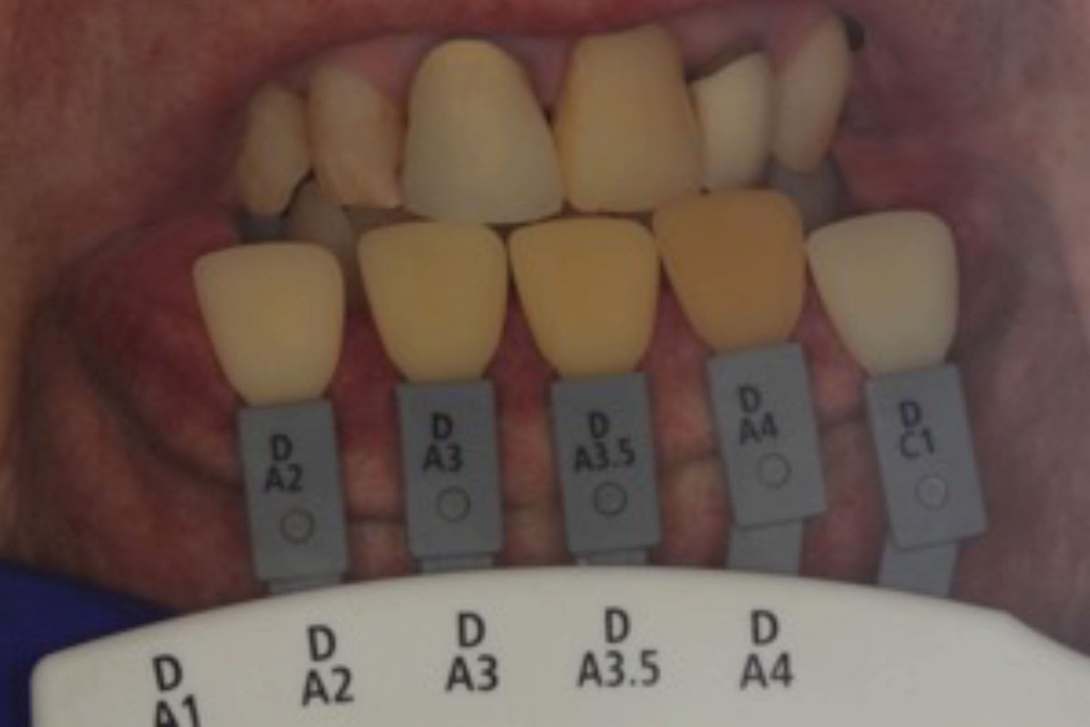 Tips for shade matching indirect restorations - Dentistry