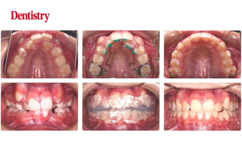 Are all arch development techniques created equal? - Dentistry
