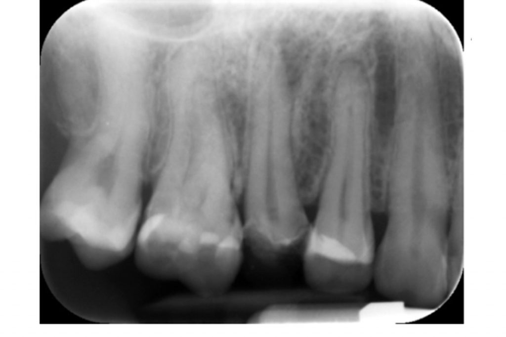 Single-visit crown lengthening and endodontics - Dentistry