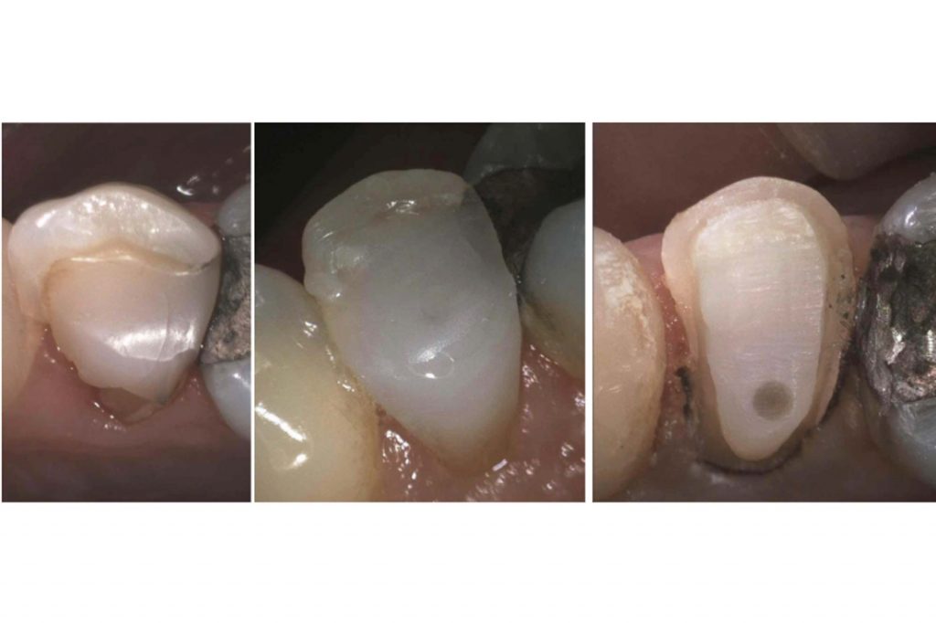 Single-visit crown lengthening and endodontics - Dentistry