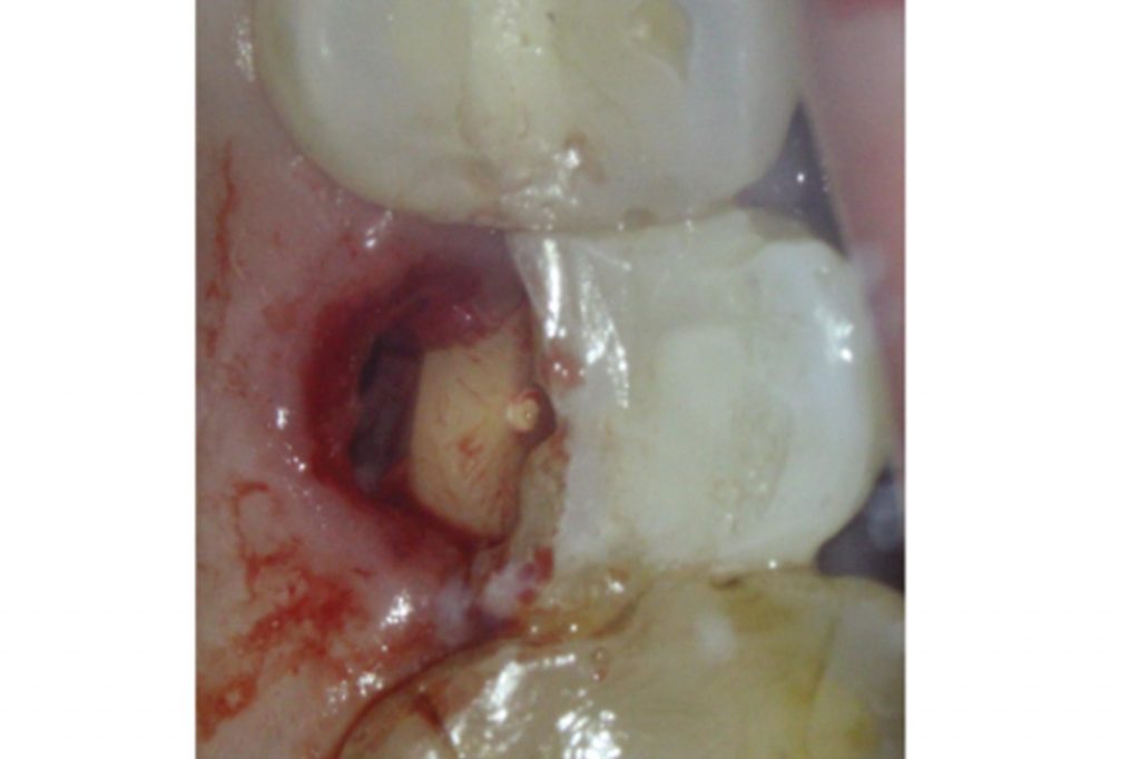 Single-visit crown lengthening and endodontics - Dentistry