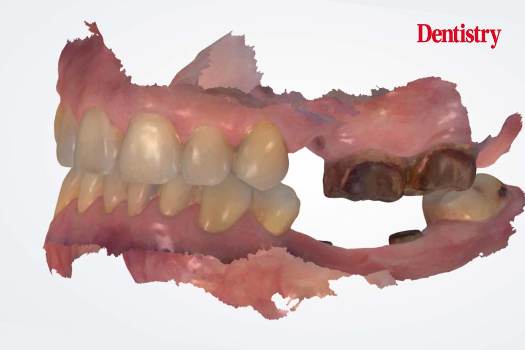 De-mystifying digital dental implants - Dentistry