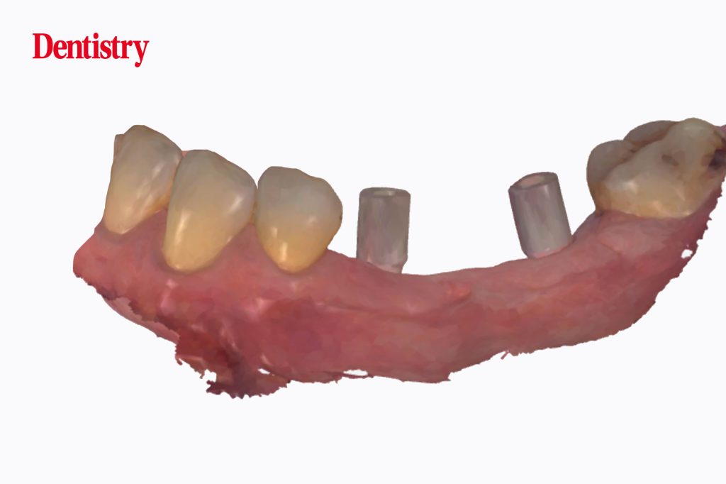 De-mystifying digital dental implants - Dentistry