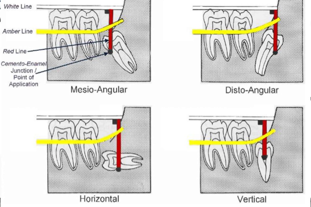 A dental student’s guide to…mandibular third molars - Dentistry