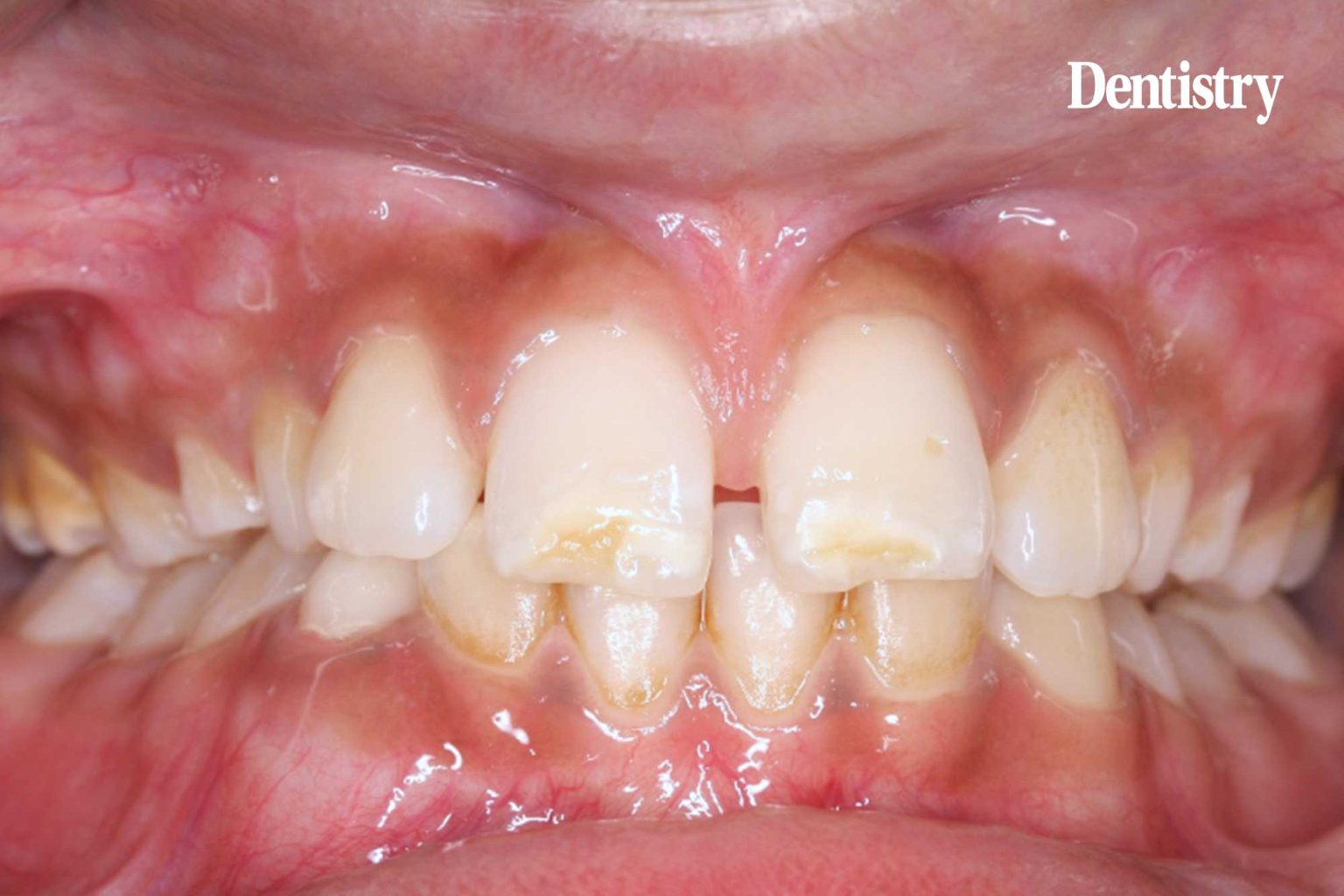 Biomin F gives relief to sufferers from MIH - Dentistry