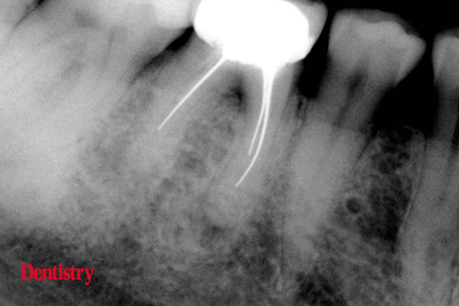 Exploring Endodontics – a silver point of order - Dentistry
