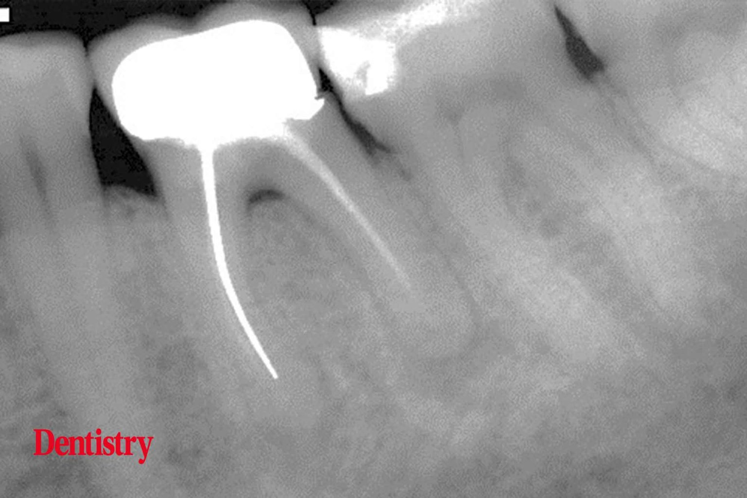 Exploring Endodontics – a silver point of order - Dentistry