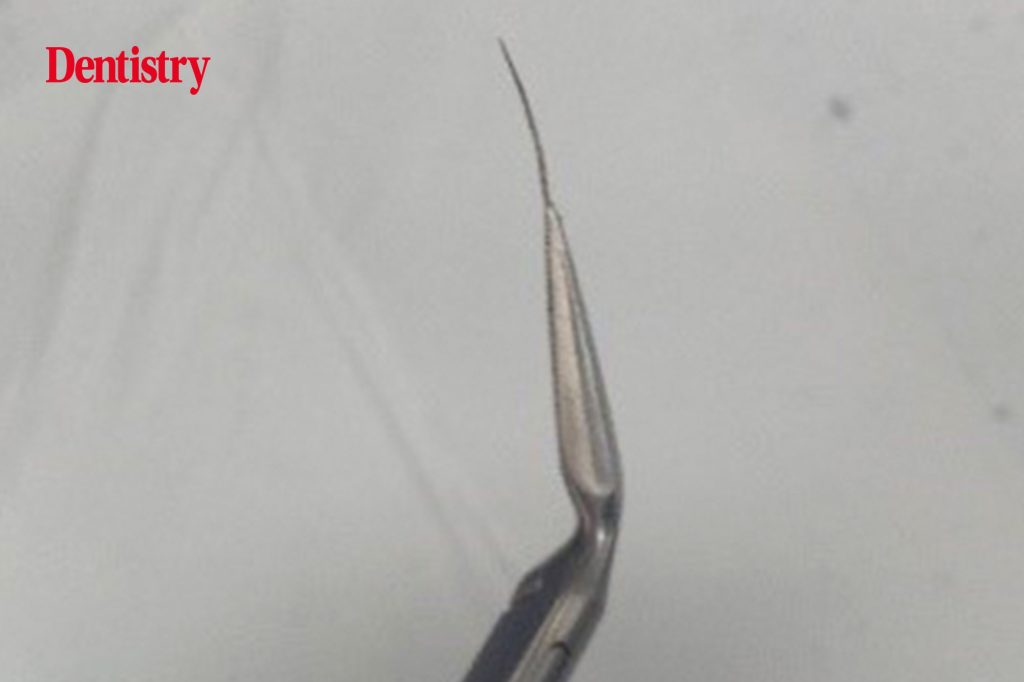 Exploring Endodontics – a silver point of order - Dentistry