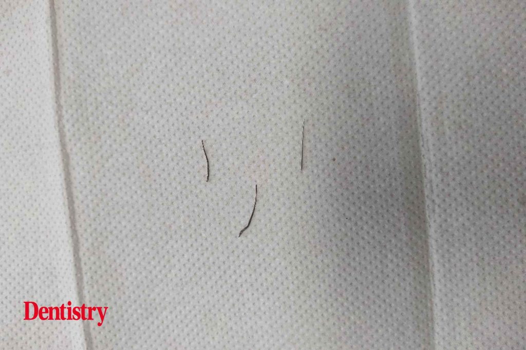 Exploring Endodontics – a silver point of order - Dentistry