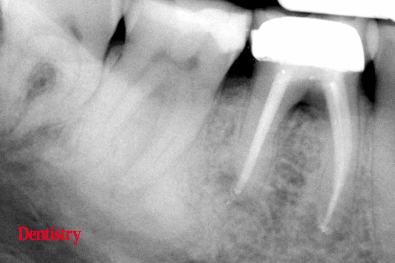 Exploring Endodontics – a silver point of order - Dentistry