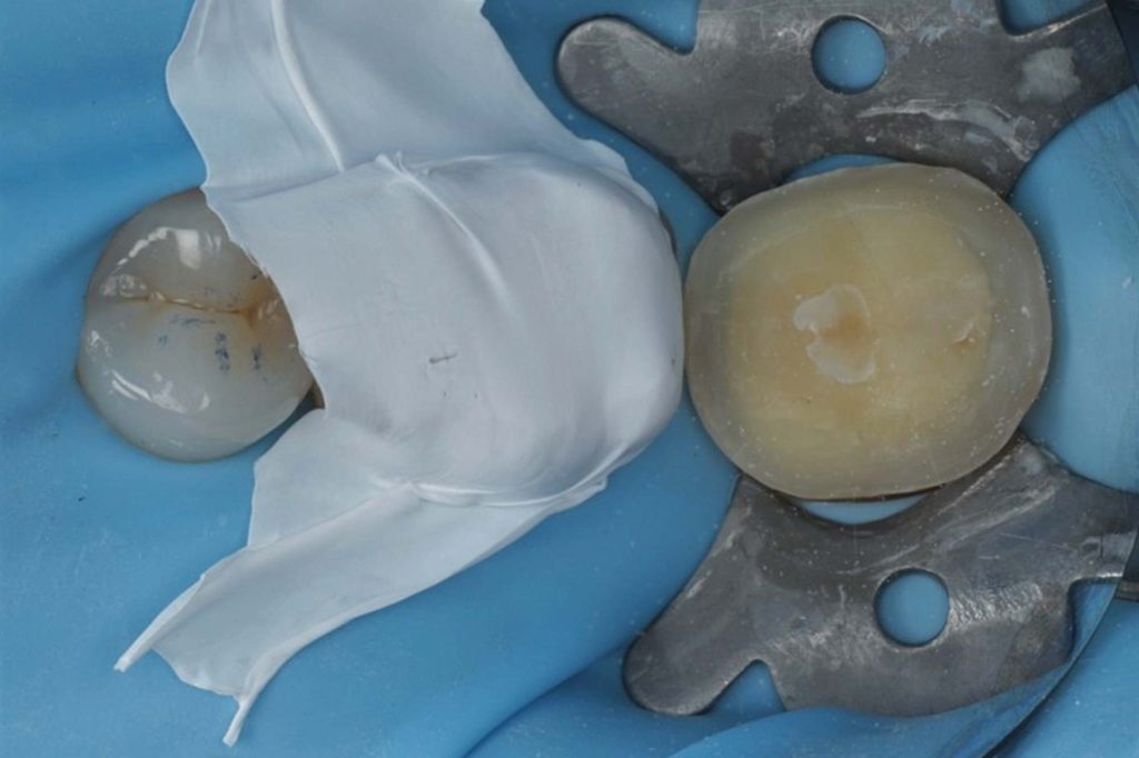 Lower-molar-figure-10 - Dentistry.co.uk