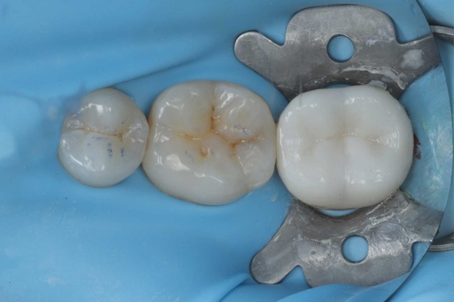 Lower-molar-figure-11 - Dentistry.co.uk