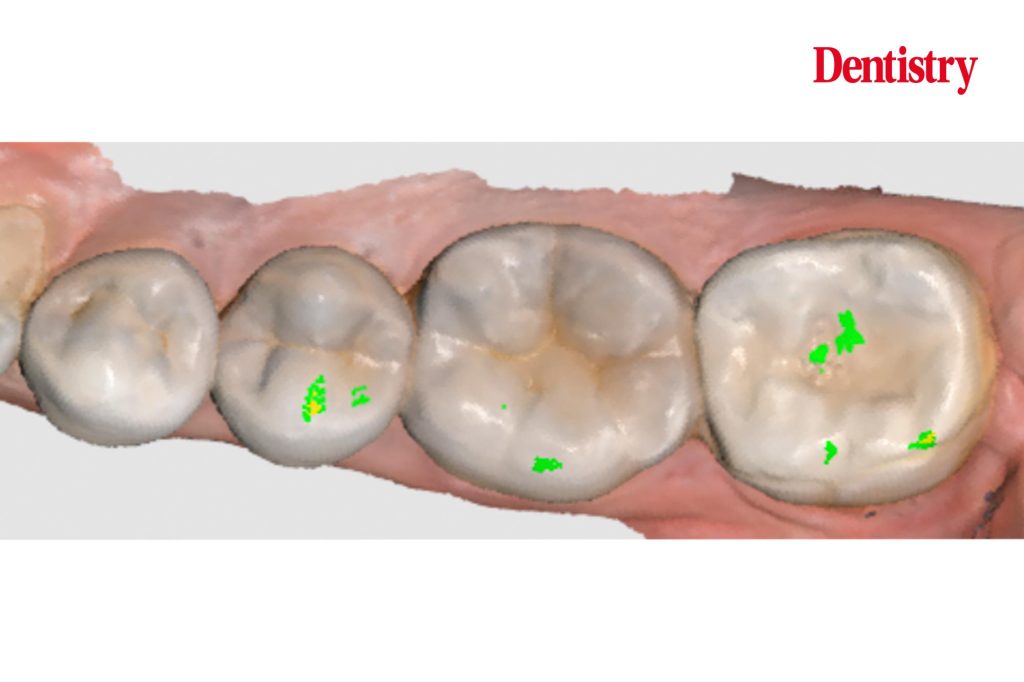 Lower-molar-figure-2 - Dentistry.co.uk
