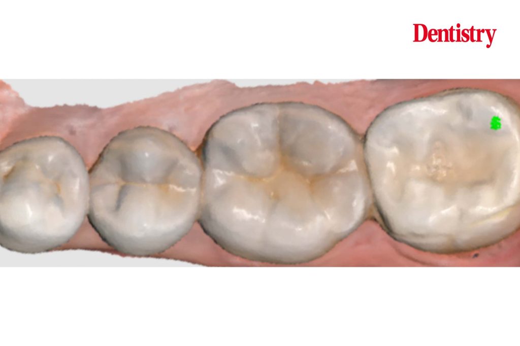 Lower-molar-figure-4 - Dentistry.co.uk
