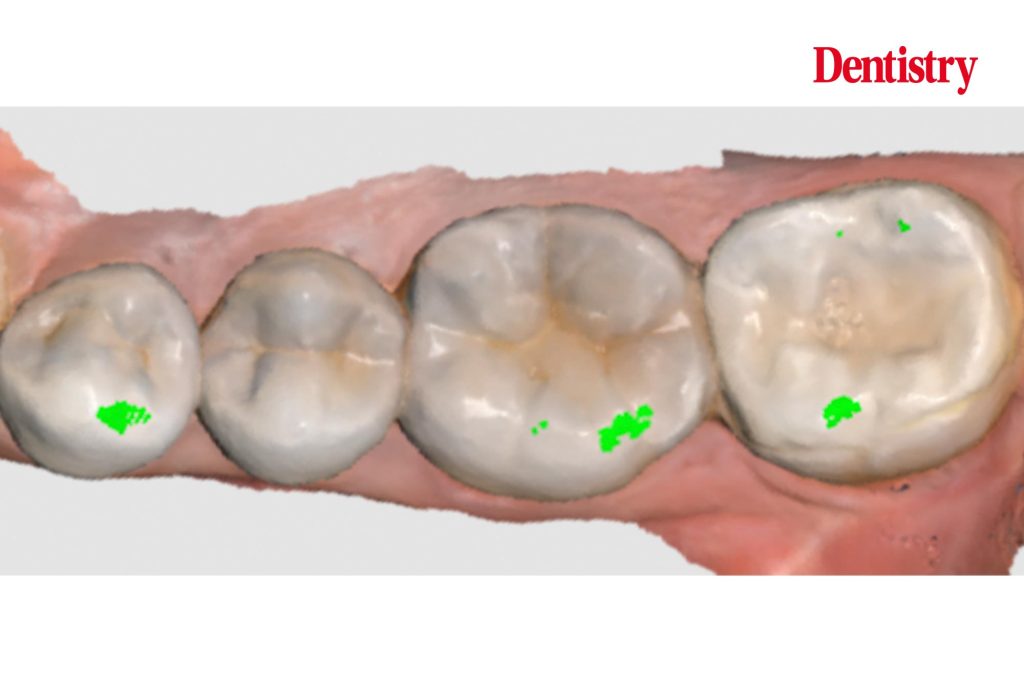 Lower-molar-figure-5 - Dentistry.co.uk