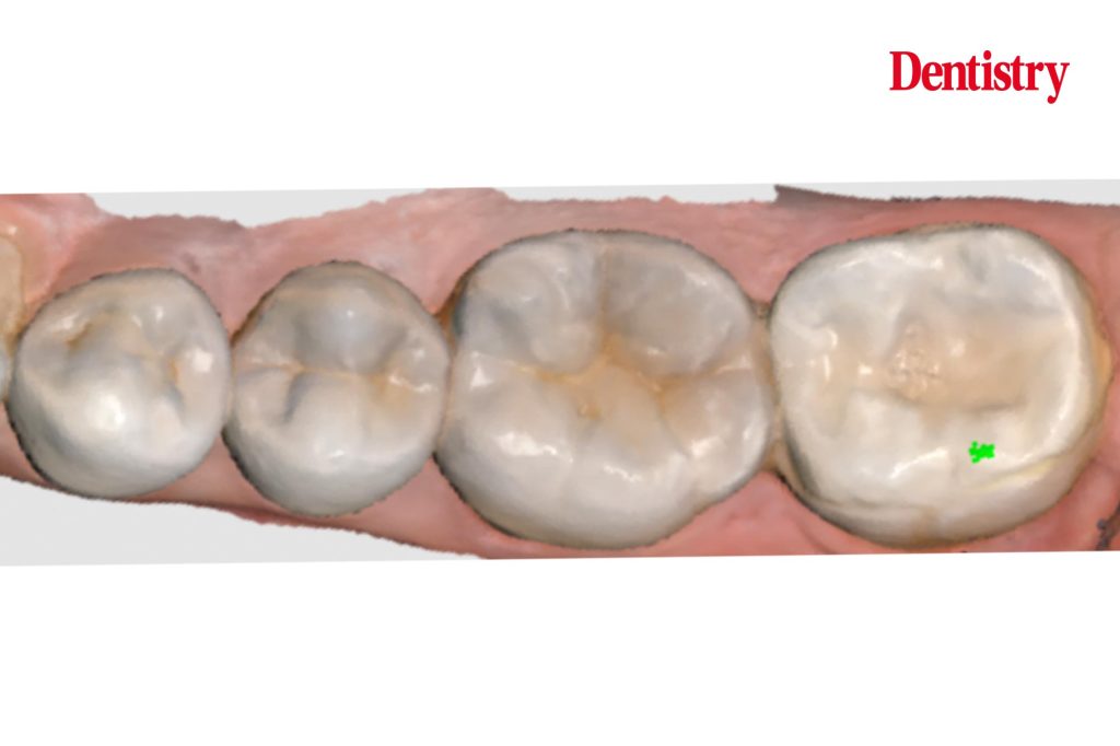 Lower-molar-figure-6 - Dentistry.co.uk
