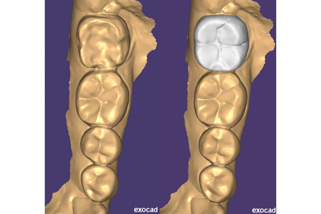 Prosthodontips – restoration of a lower second molar - Dentistry