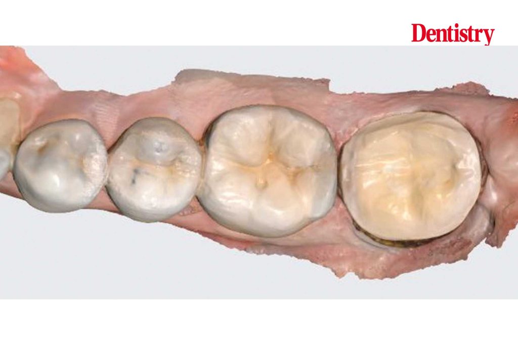 Prosthodontips – restoration of a lower second molar - Dentistry