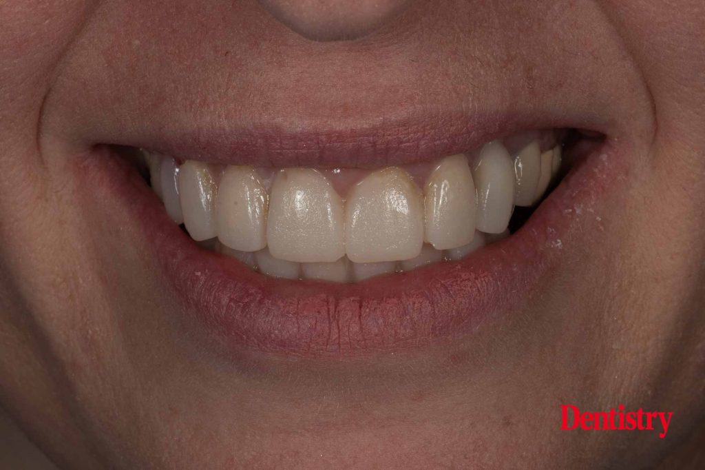 Prosthodontips – smile design - Dentistry