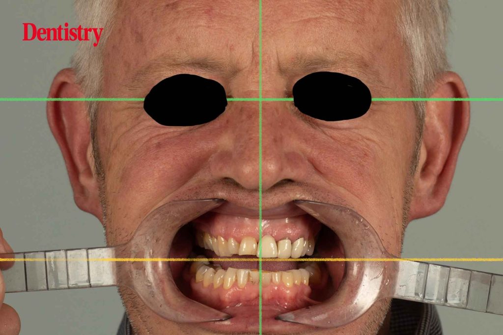 Prosthodontips – smile design - Dentistry