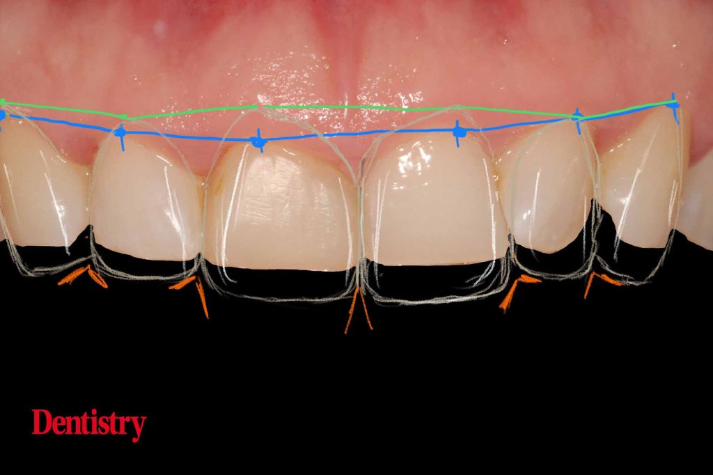 Prosthodontips – smile design - Dentistry