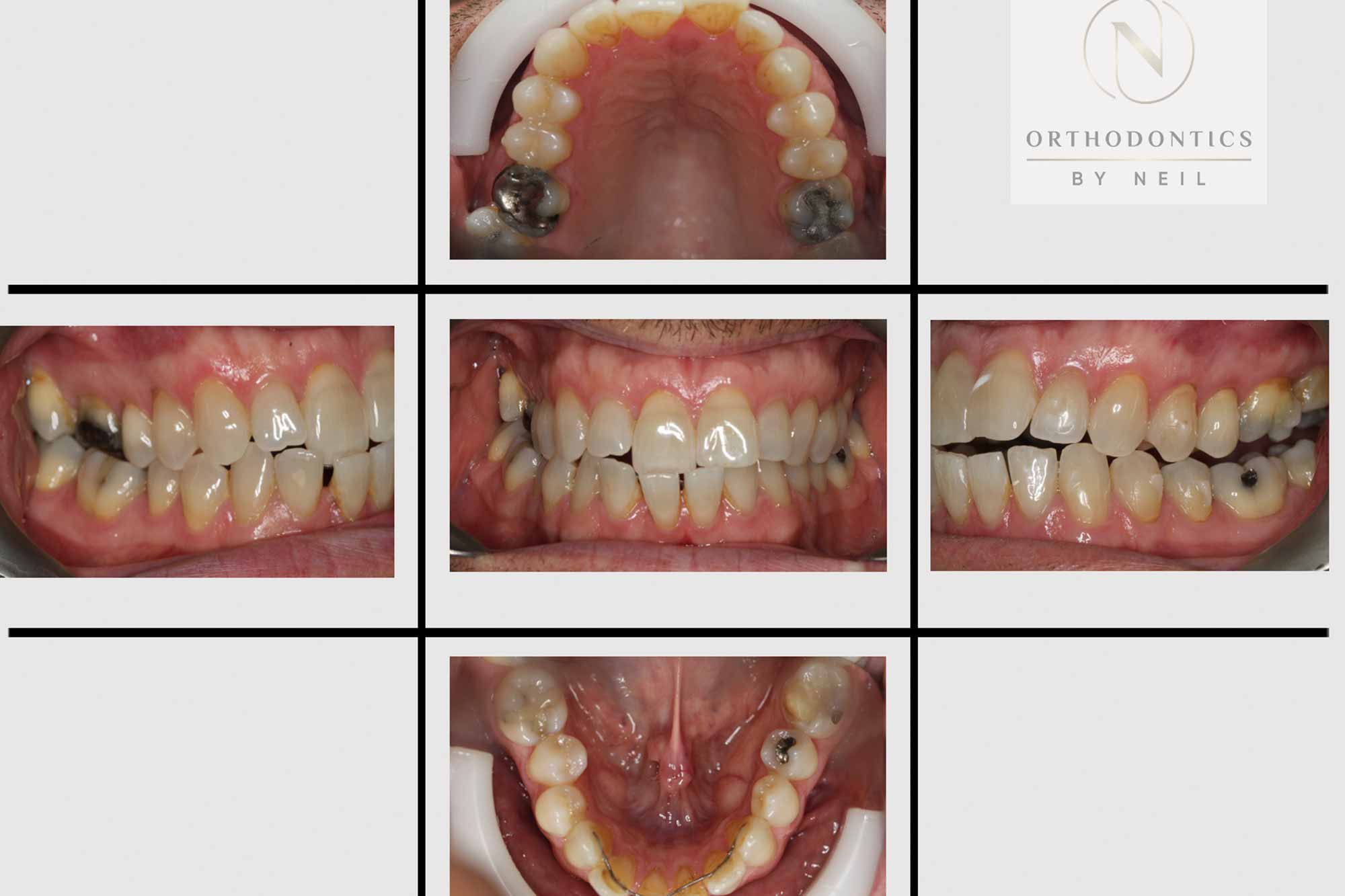 Invisalign-Fig-4 - Dentistry.co.uk