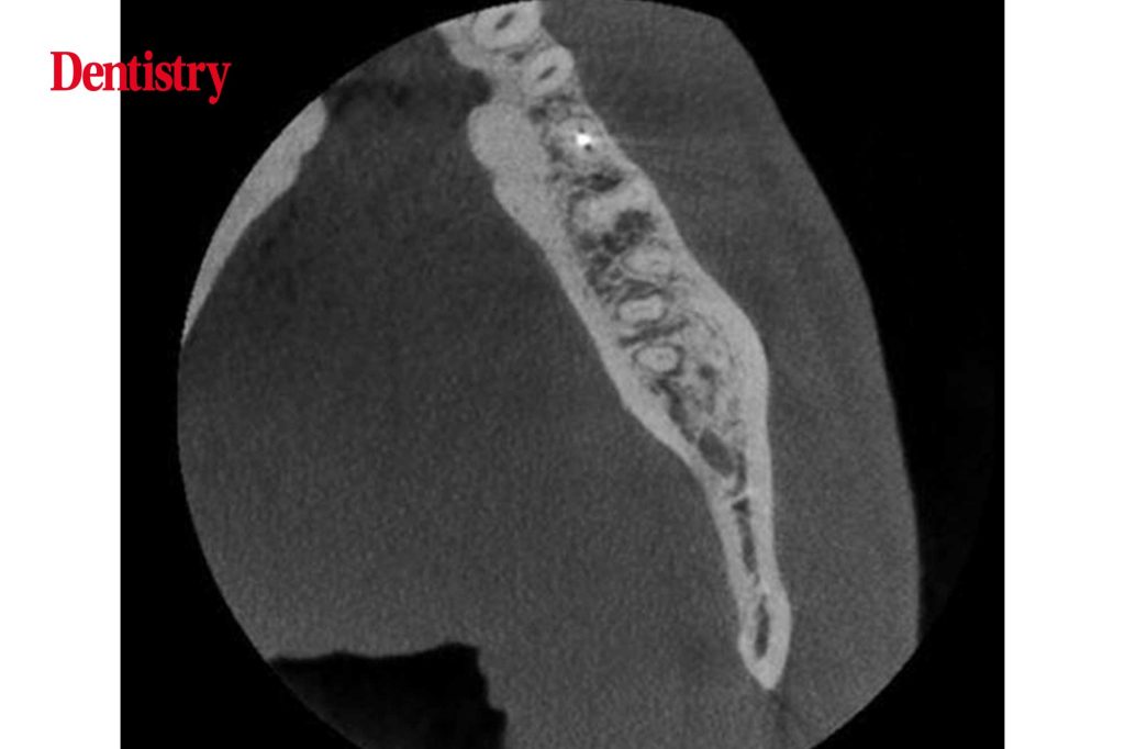 Case of the week – relationship with the inferior dental nerve - Dentistry