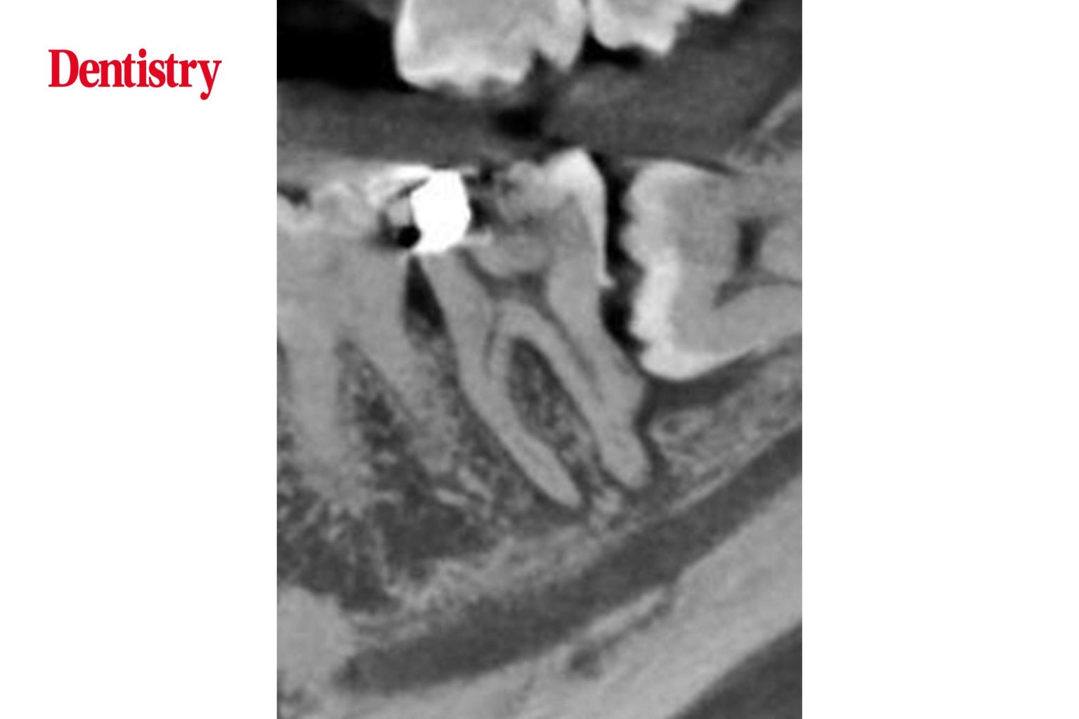Case of the week – relationship with the inferior dental nerve - Dentistry