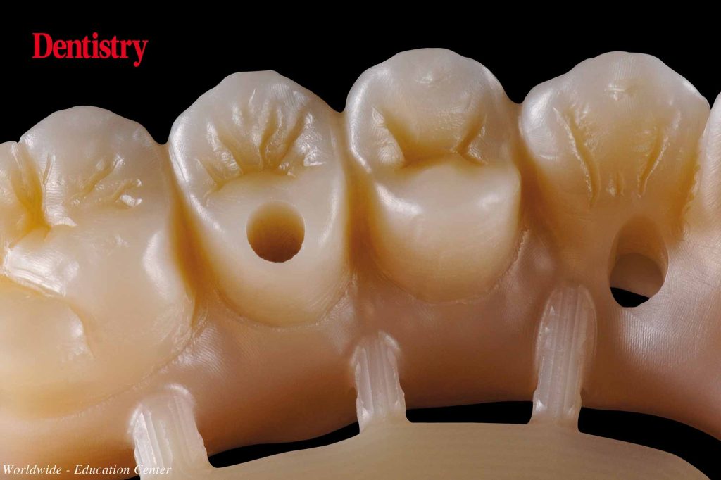 Bar-supported bridges made of Prettau 2 Dispersive - Dentistry